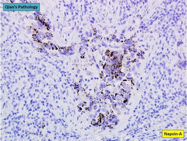 Adenocarcinoma of Lung : Napsin A
