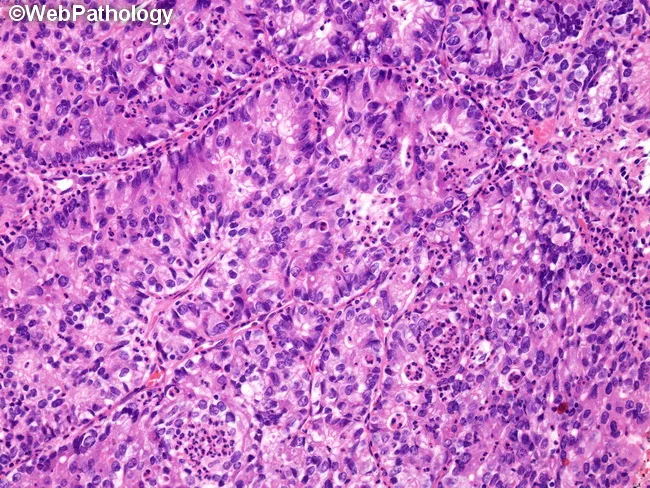 Enteric AdenoCA of Lung