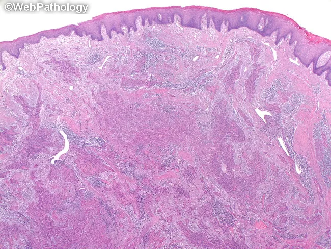 Mucoepidermoid Carcinoma : Int. grade