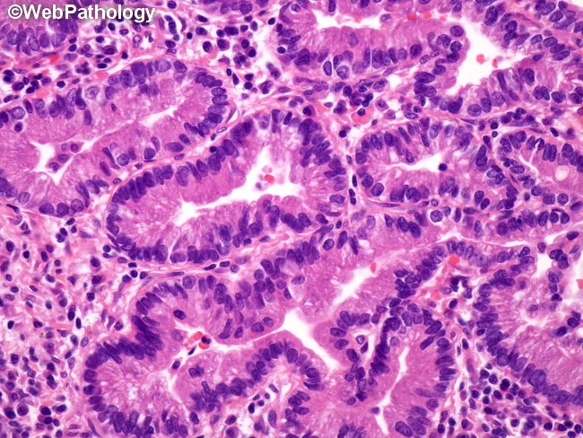 Enteric AdenoCA of Lung