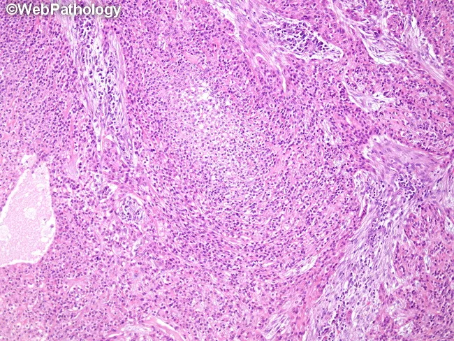 Mucoepidermoid Carcinoma : Int. grade