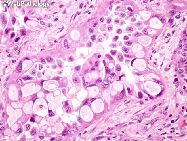 Lung AdenoCA : Signet Ring-cell Pattern