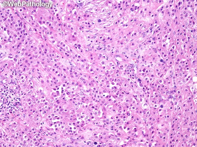 Mucoepidermoid Carcinoma : Int. grade
