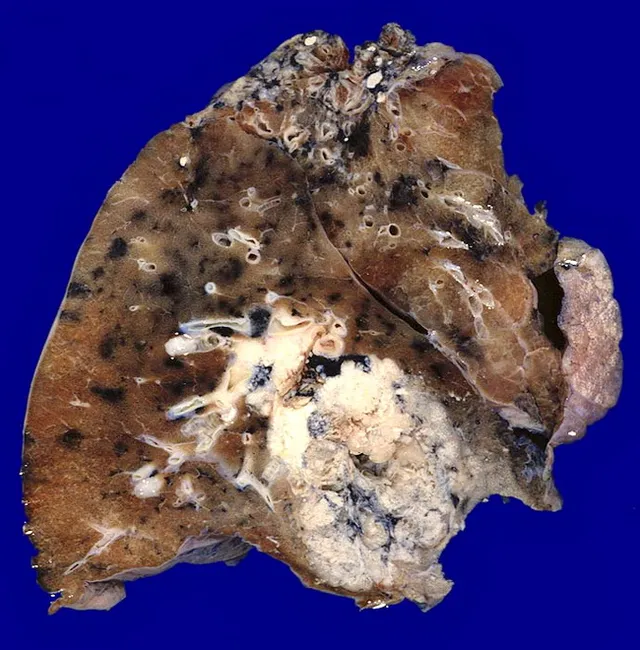 Squamous Cell Carcinoma : Gross