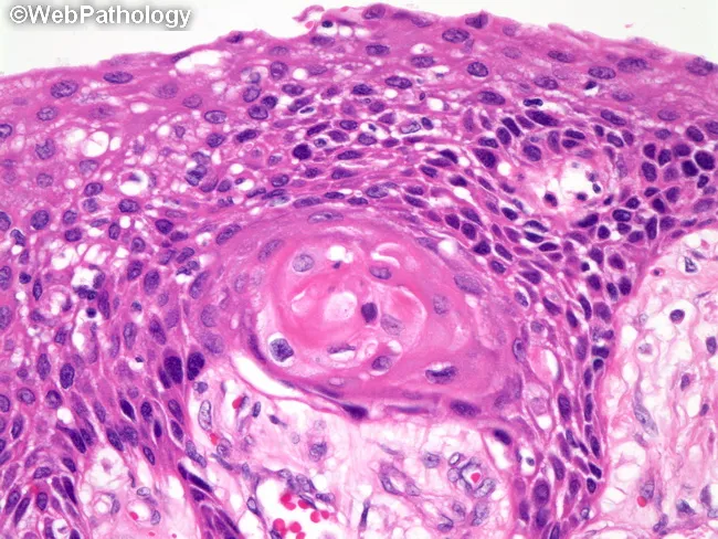 intercellular bridges pathology