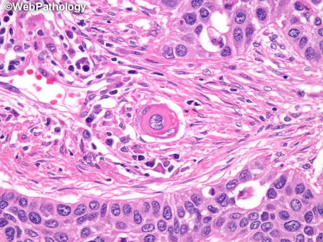 intercellular bridges pathology
