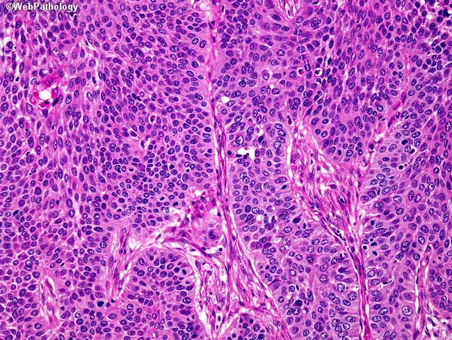 Squamous Cell Carcinoma