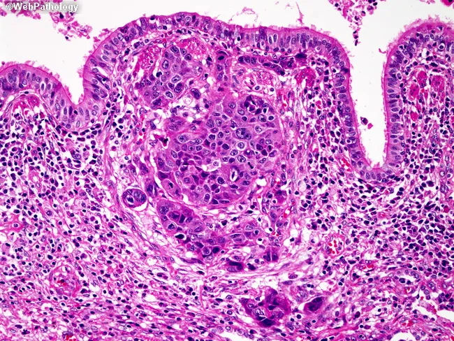 Squamous Cell Carcinoma : Molecular Genetics