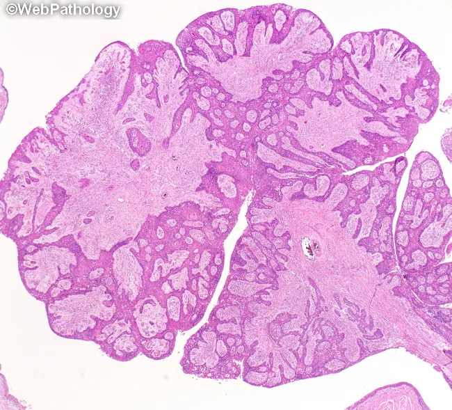 Squamous Cell Carcinoma : Papillary