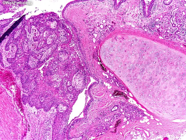 Squamous Cell Carcinoma : Papillary