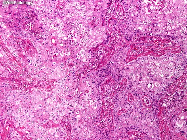 Squamous cell carcinoma : Differential