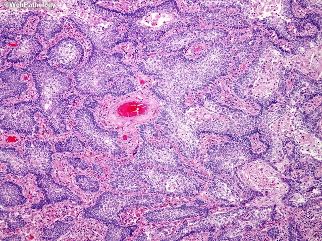 Basaloid Squamous Cell Carcinoma
