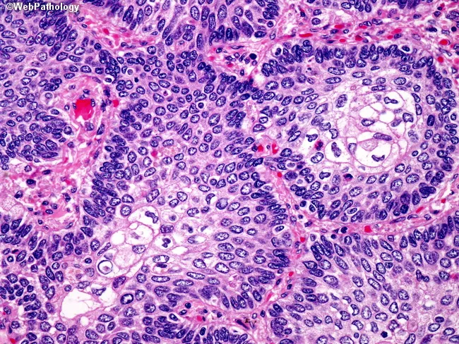 Basaloid Squamous Cell Carcinoma
