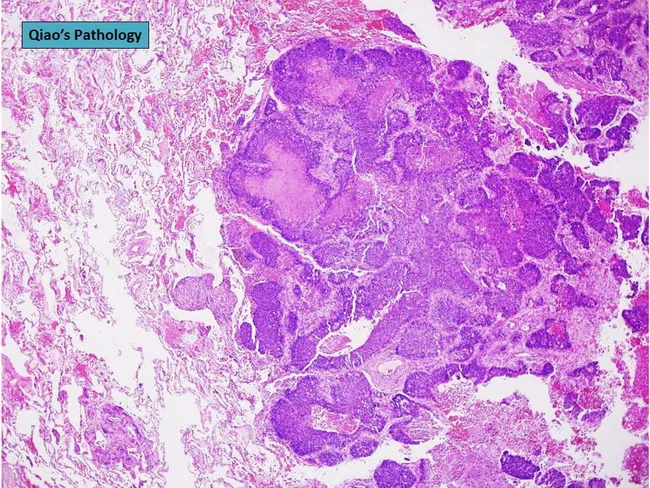 Basaloid Squamous Cell Carcinoma