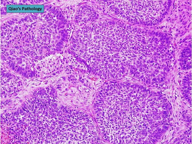 Basaloid Squamous Cell Carcinoma