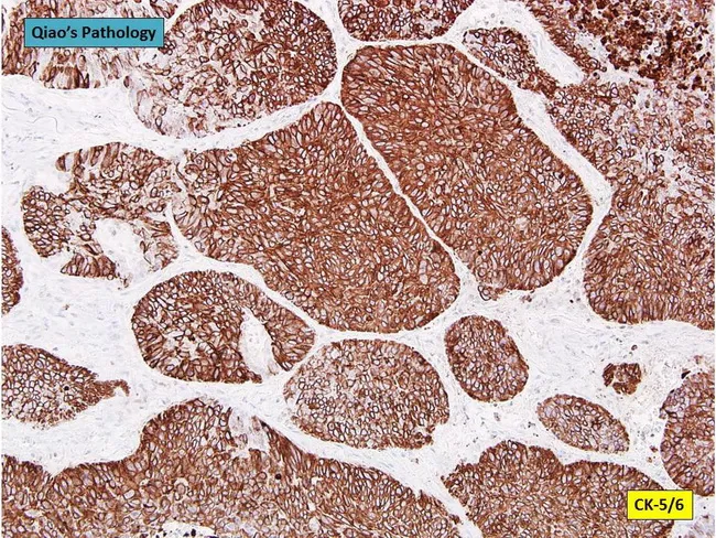 Basaloid Squamous Cell Carcinoma : CK5/6