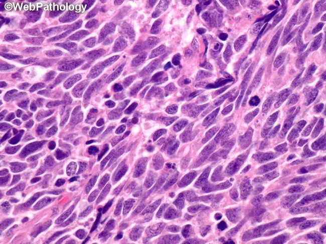 Small Cell Carcinoma