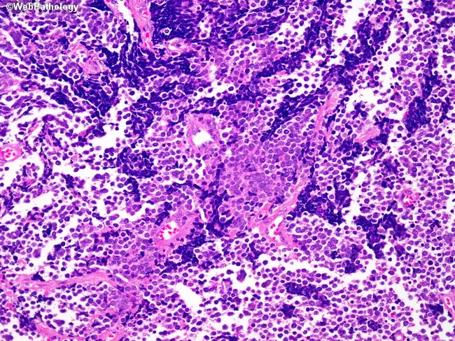 Small Cell Carcinoma
