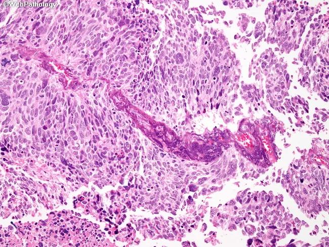 Small Cell Carcinoma : Azzopardi Effect