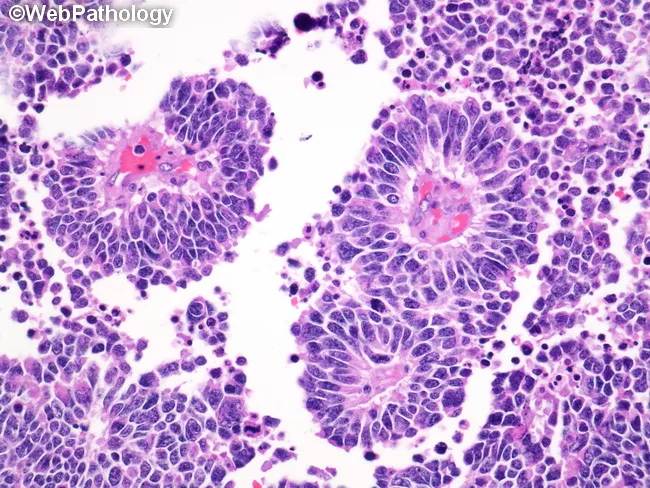 Small Cell Carcinoma : Differential Diagnosis