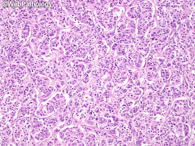 Carcinoid : Nesting Pattern