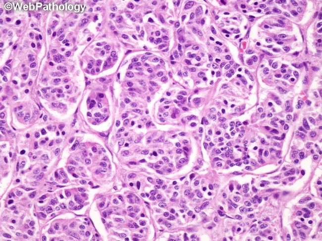 Carcinoid : Nesting Pattern