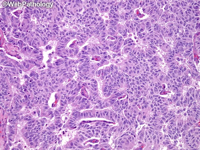 Carcinoid : Trabecular Pattern