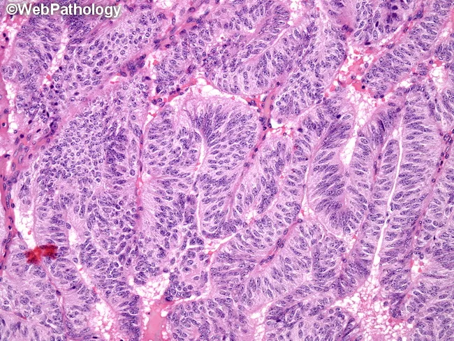 Carcinoid : Trabecular Pattern