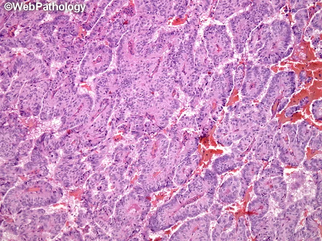 Carcinoid : Papillary Pattern