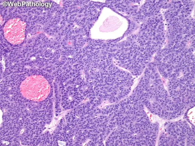 Carcinoid : Rosettes