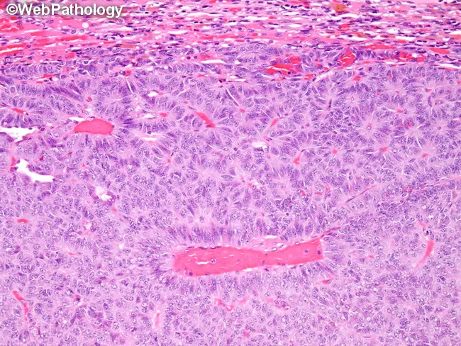 Carcinoid : Rosettes