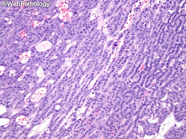 Carcinoid : Retiform & Trabecular