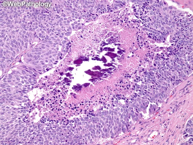 Atypical Carcinoid