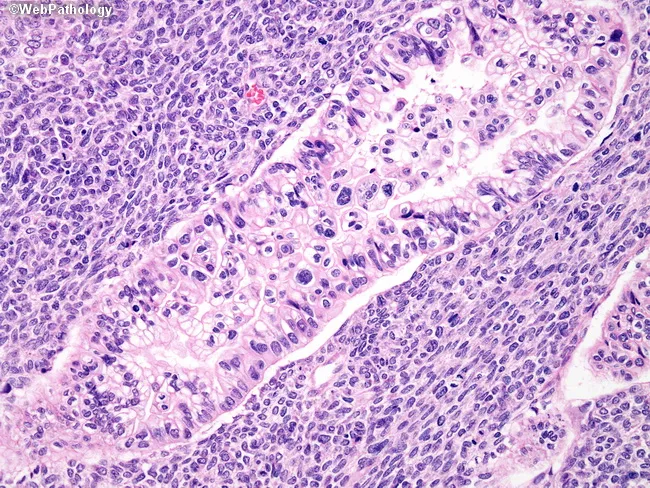 Pulmonary Blastoma