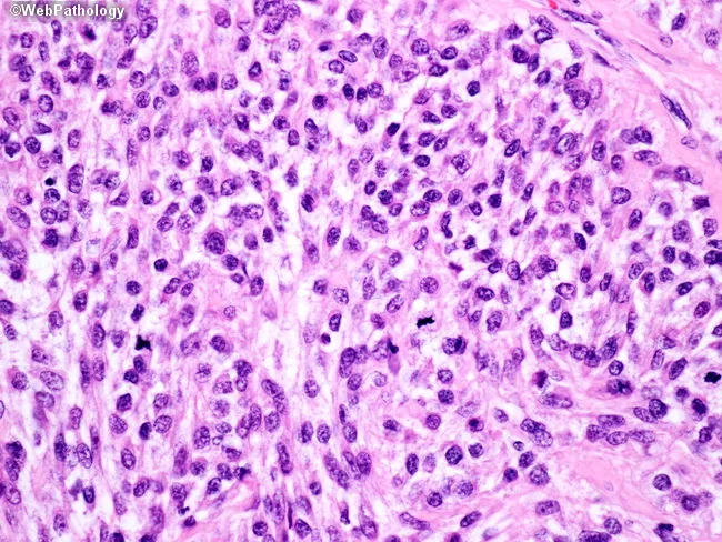 Embryonal Rhabdomyosarcoma of Lung