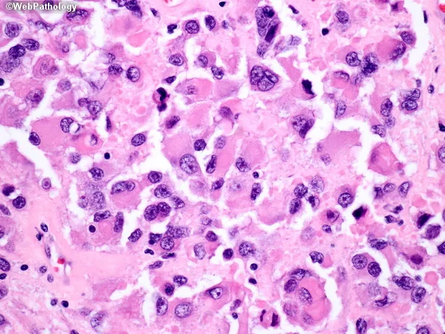 Embryonal Rhabdomyosarcoma of Lung