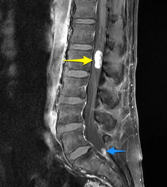 Myxopapillary Ependymoma : MRI Scan