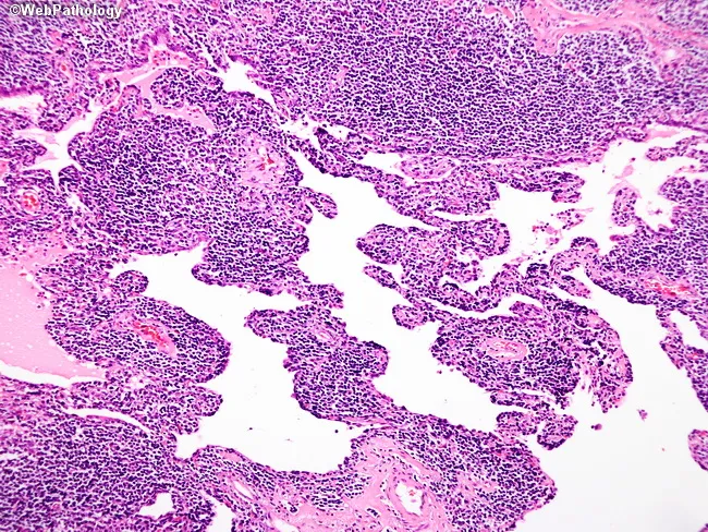 Marginal Zone B-cell Lymphoma (MALTOMA)
