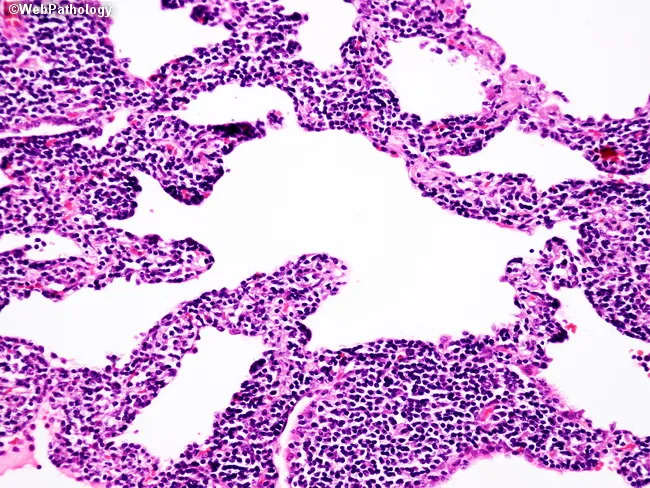 Marginal Zone B-cell Lymphoma (MALTOMA)
