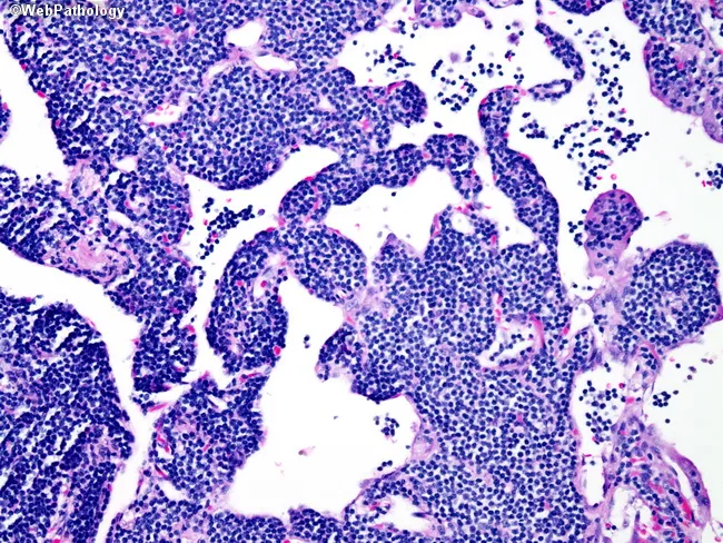 Marginal Zone B-cell Lymphoma (MALTOMA)