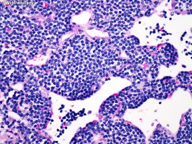 Marginal Zone B-cell Lymphoma (MALTOMA)
