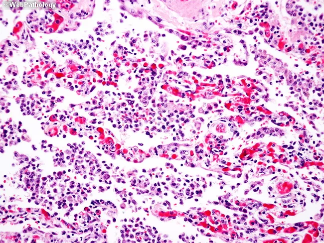 Lung Involvement in Acute Myeloid Leukemia