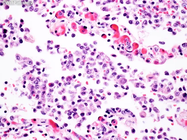 Lung Involvement in Acute Myeloid Leukemia