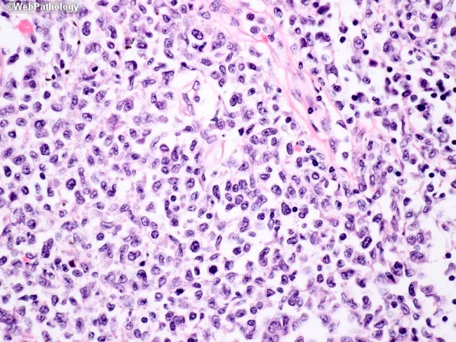 Lung Involvement in Acute Myeloid Leukemia