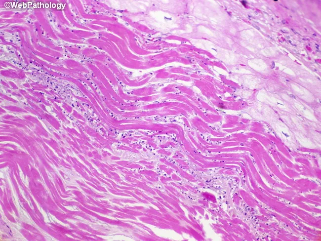 coagulation necrosis