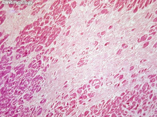 Myocardial Infarction Pathology Pathology Of Myocardial Infarction