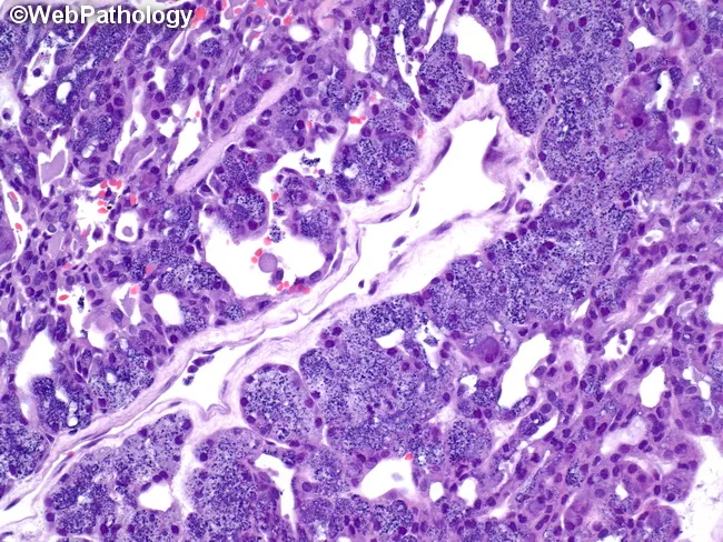 Acinic Cell Carcinoma : Treatment