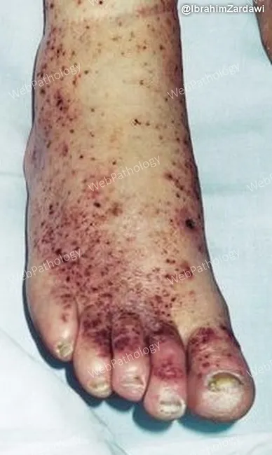 Infective Endocarditis