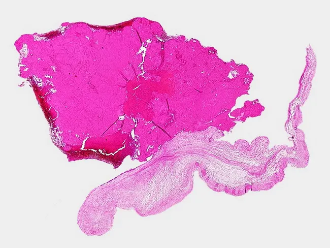 Non-bacterial Thrombotic Endocarditis