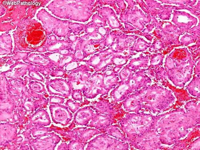 Myxopapillary Ependymoma